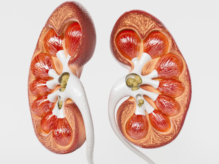 Which is Better for Diagnosing Kidney Stones, CT or Ultrasound? - RAI
